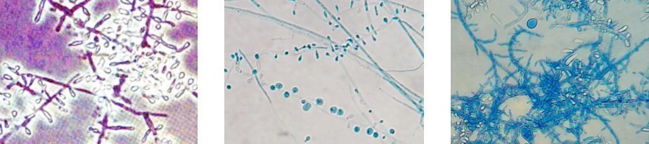 پل ایده‌آل پارس | ترایکوفایتون تونسورانس