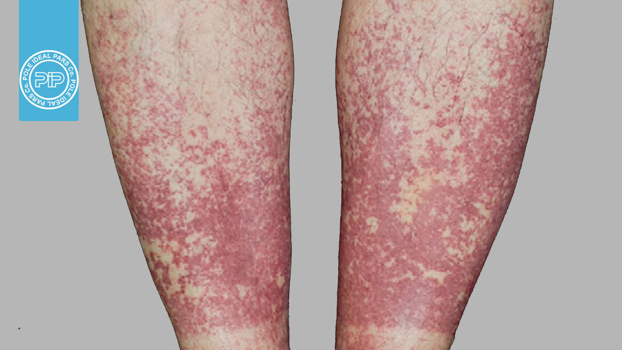 مطالعه موردی : مردی 30 ساله که به تازگی مبتلا به کم خونی آپلاستیک شده ...