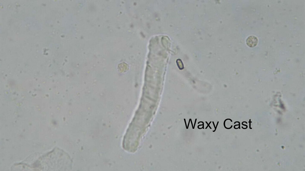 مروری بر سیلندرهای ادراری و انواع آن در آزمایش ادرار - مجله پل ایده‌آل پارس