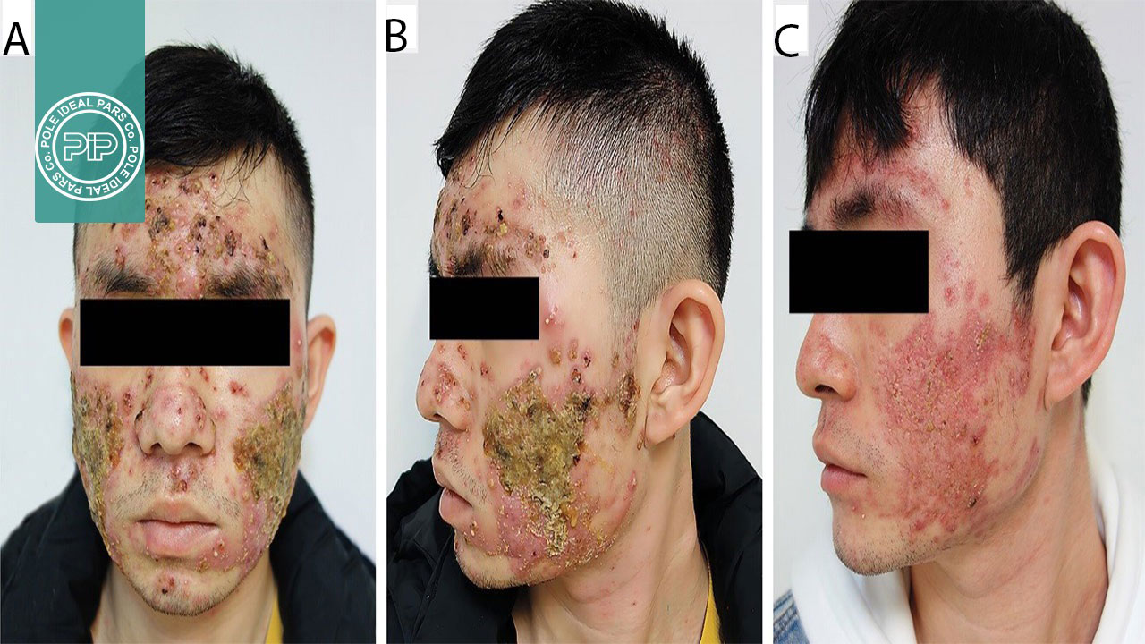 مطالعه موردی: بررسی بیمار مبتلا به آکنه فولمینانس - مجله پل ایده‌آل پارس