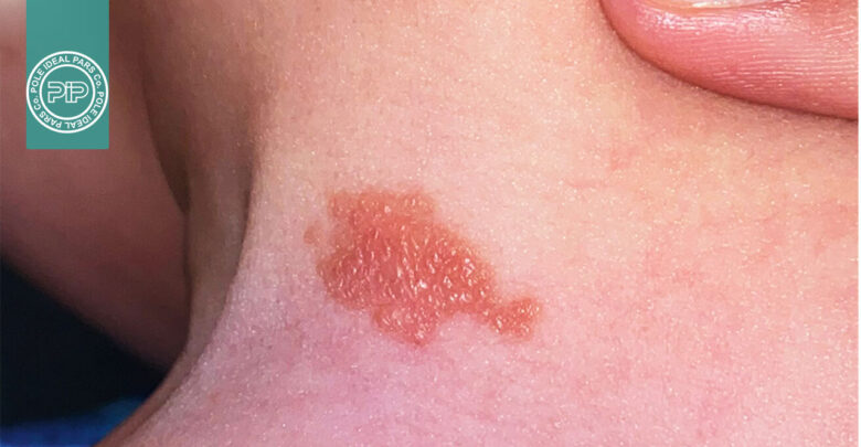 علامت داریر (Darier’s Sign) در ماستوسیتوم منفرد - مجله پل ایده‌آل پارس